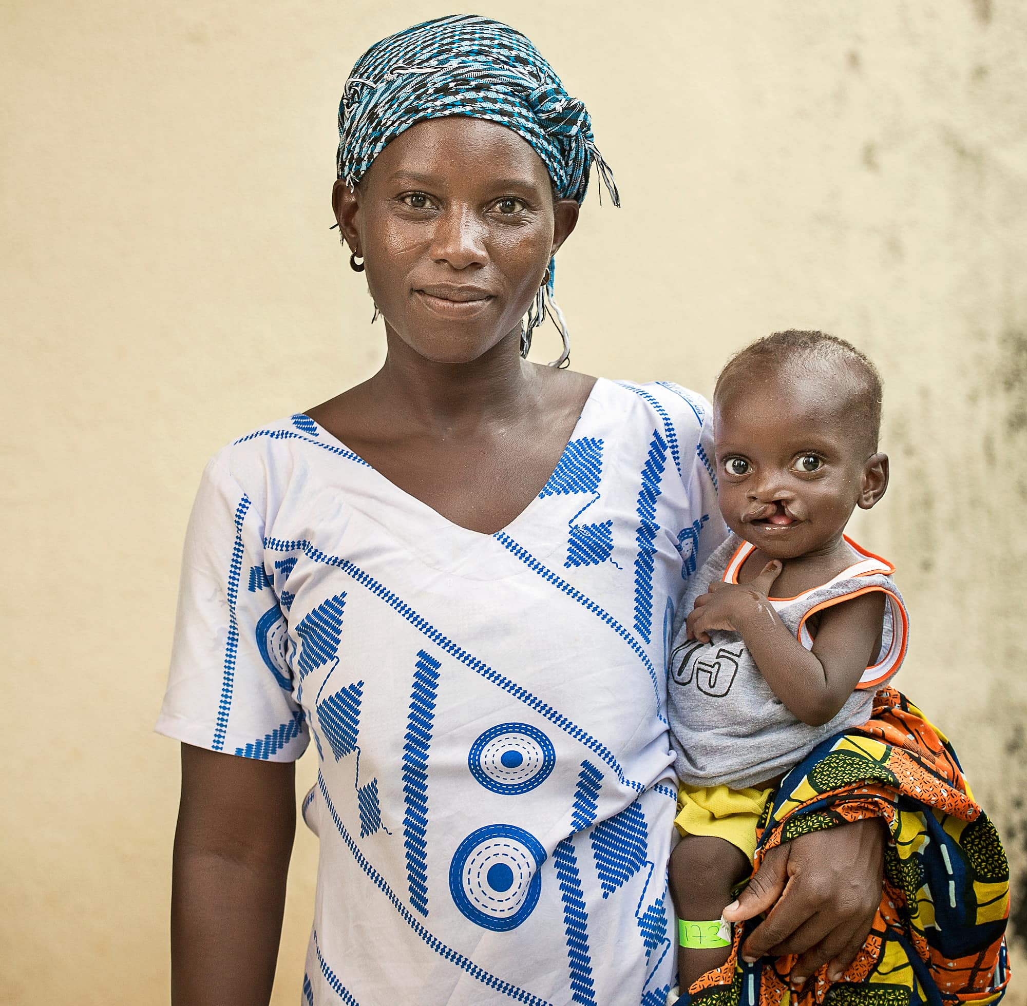 A new life for Moses - Cleft Lip & Palate Children's Charity ...