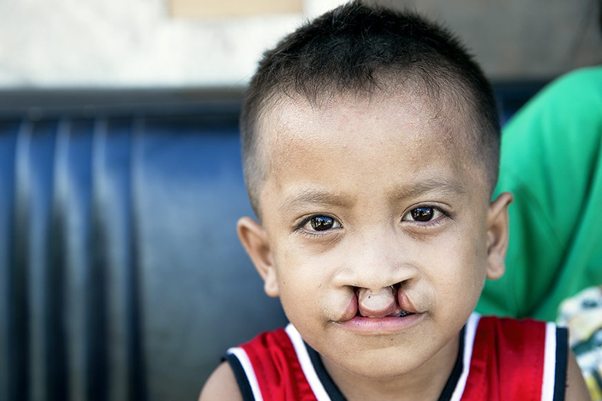 Cleft Lip & Cleft Palate Children's Charity - Cleft Lip & Palate ...