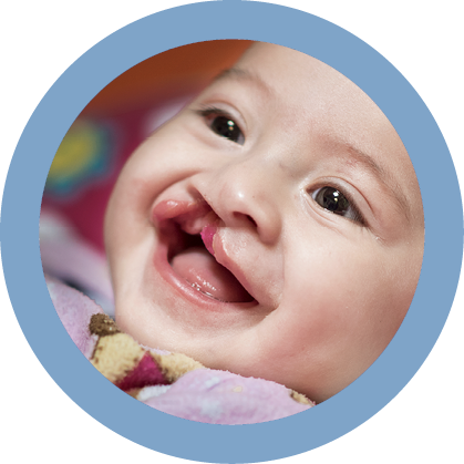 Behind a smile - Cleft Lip & Palate Children's Charity | Operation Smile UK