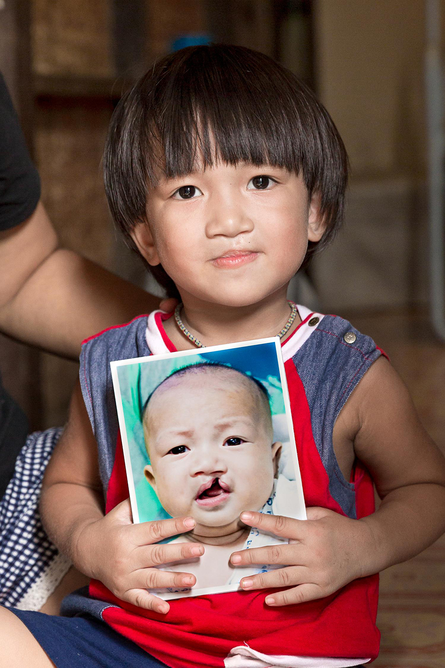 Meet our patients: Thailand - Cleft Lip & Palate Children's Charity ...
