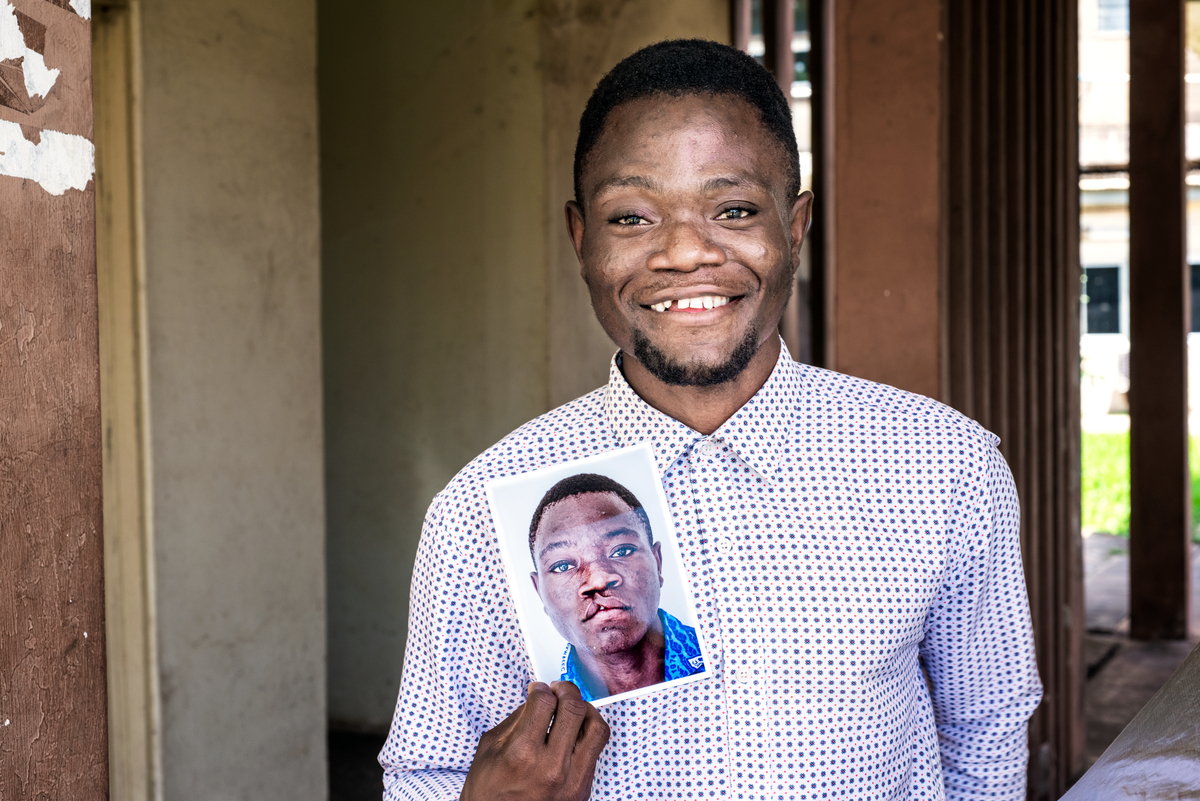 From despair to freedom – Samuel’s story - Cleft Lip & Palate Children ...